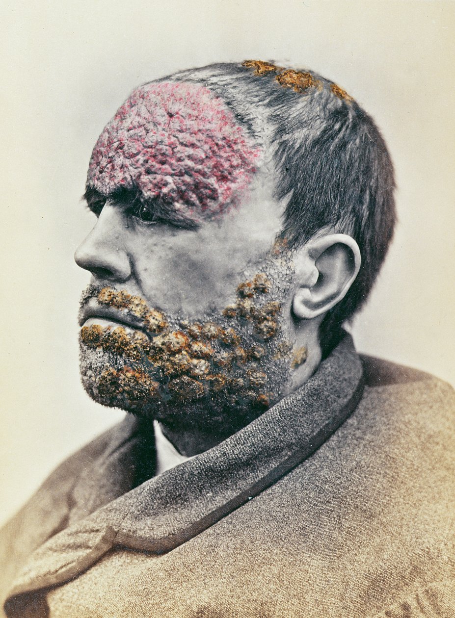 Mann leidet an Syphilis, aus einem Foto für die Clinique Photographique ...